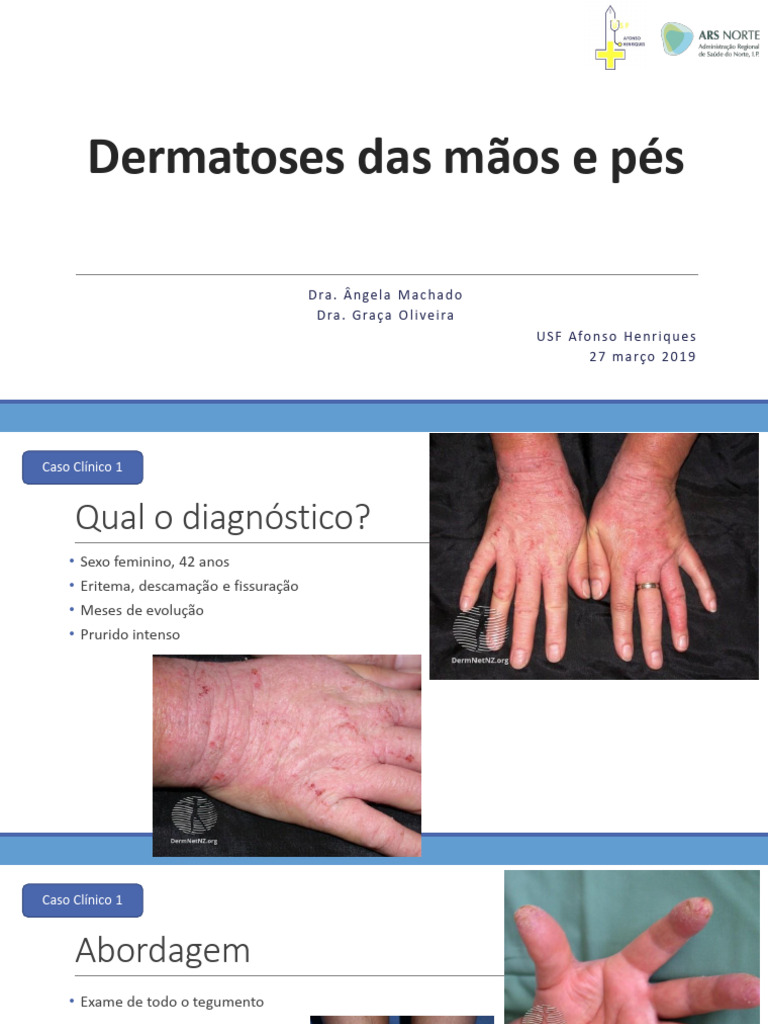 Revisão de Tema Dermatoses Das Mãos e Pés | PDF