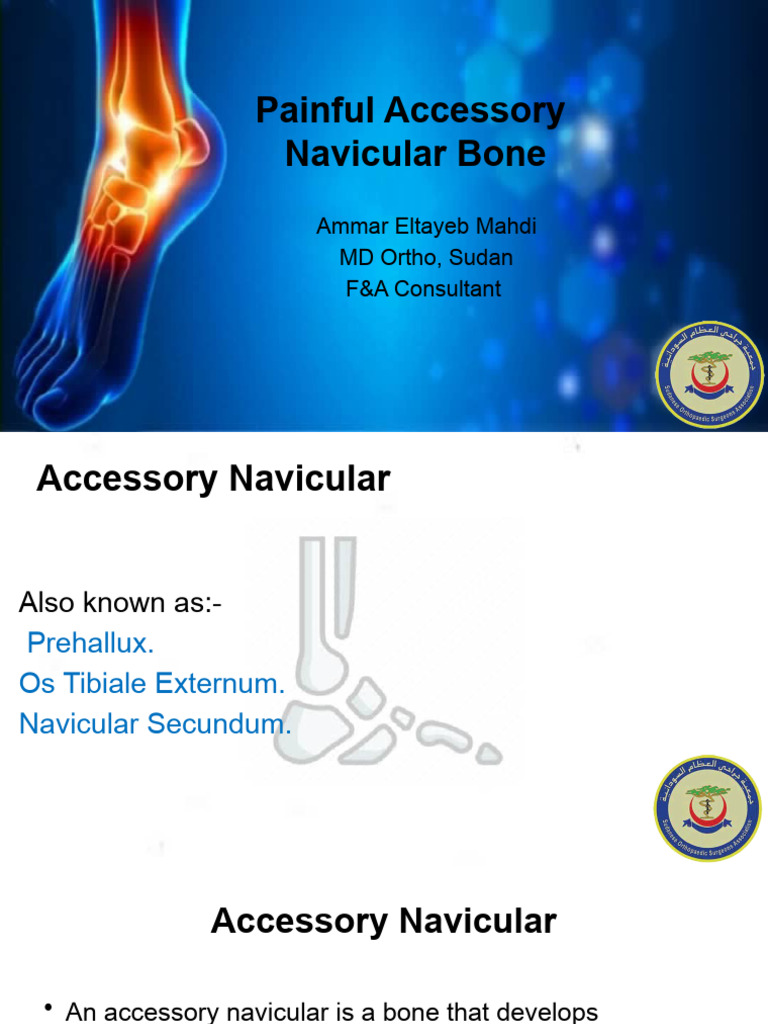 Painfull Accessory Navicular Bone | Download Free PDF | Foot | Surgery