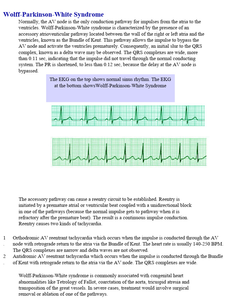Wolff Parkinson White Syndrome | PDF