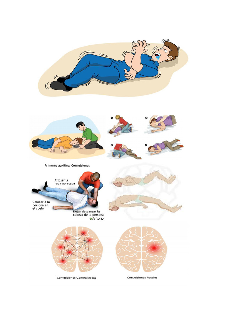 Convulsiones Consulta imagenes | PDF