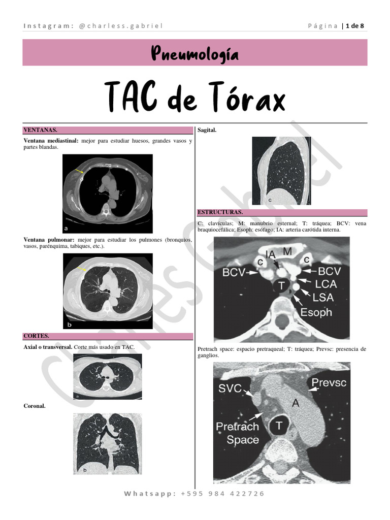 2 - TAC de Tórax | PDF | Pulmón | Ct Scan