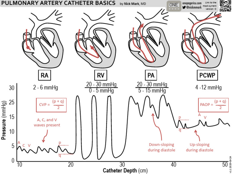 Pulmonary Artery Waveform Basics | PDF | Pressure | Cardiovascular System