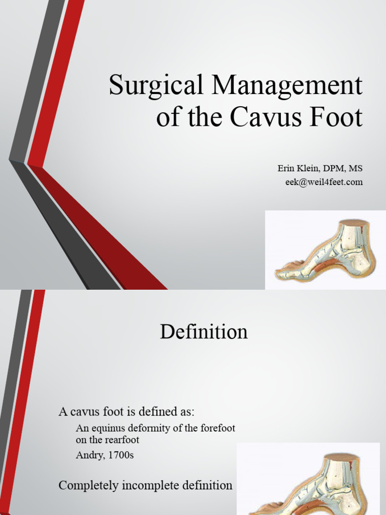 2023 Cavus Foot Surgery | PDF | Foot | Ankle