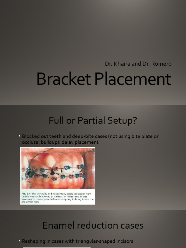 Bracket Placement | PDF