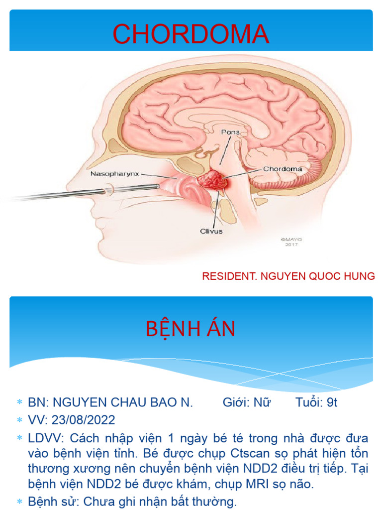 Chordoma | PDF