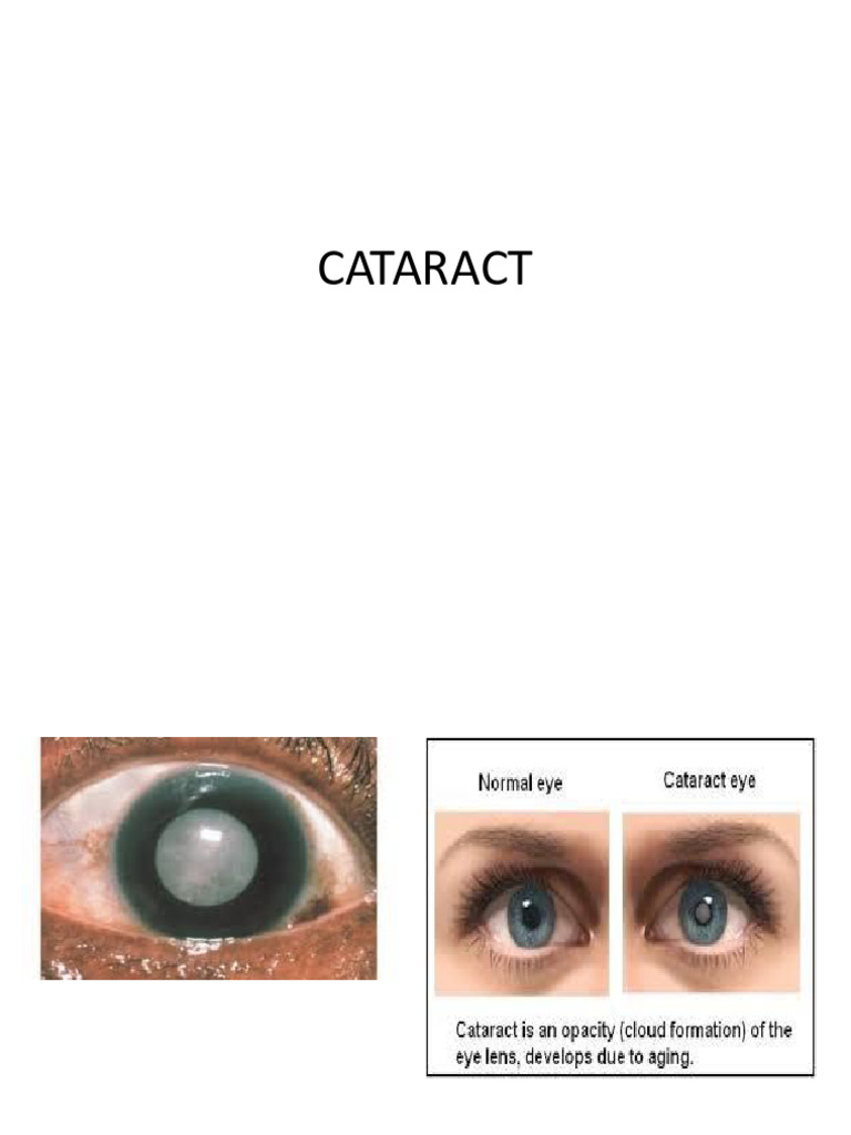 Cataract 1 | PDF | Cataract | Visual System