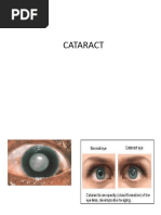 Cataract Coding Guidelines and ICD-10 | PDF | Cataract | Glaucoma