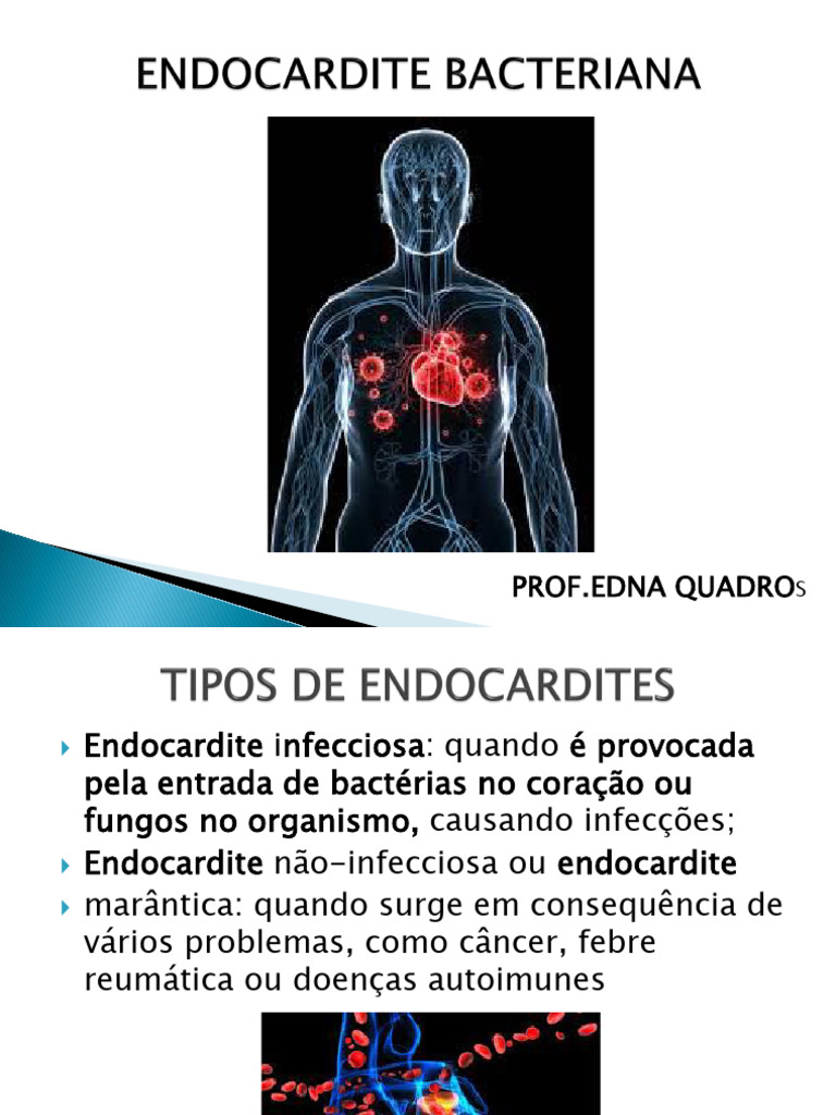 Endocardite Bacteriana | PDF | Coração | Infecção
