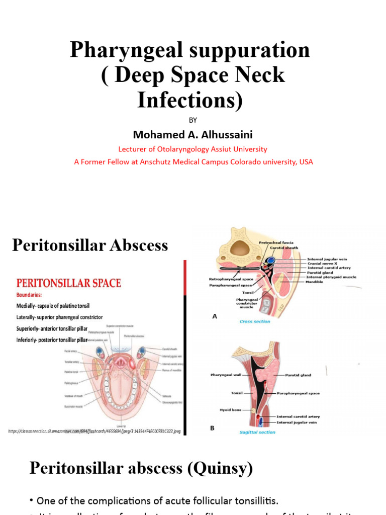 Pharyngeal Suppuration | PDF | Pneumonia | Medical Specialties