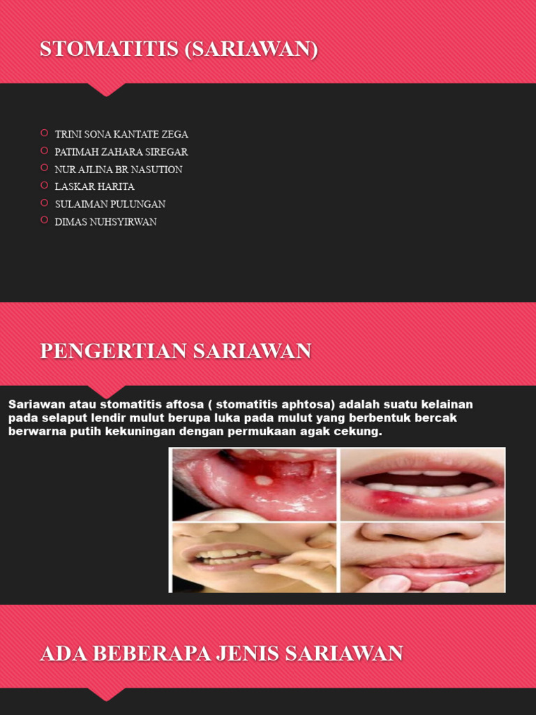 Stomatitis (Sariawan) | PDF