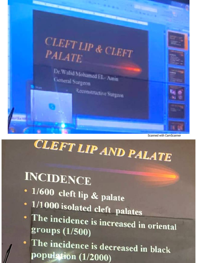Cleft Lip | PDF
