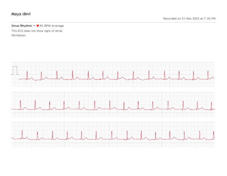 ECG Report: Sinus Rhythm Analysis | PDF