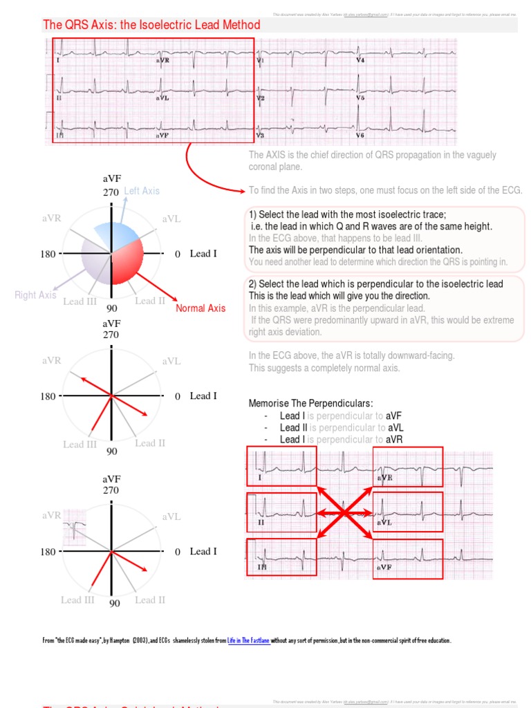 ECG Interpretation - Axis and Conduction Abnormalities ...