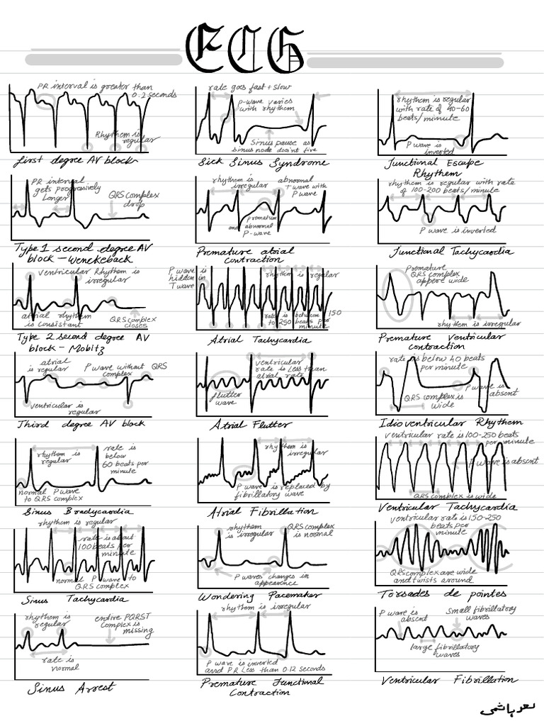 21 ECG conditions | PDF | Cardiovascular Diseases | Cardiovascular Physiology