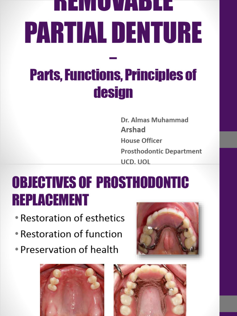 RPD 170414184927 | PDF | Dentures | Dentistry Branches