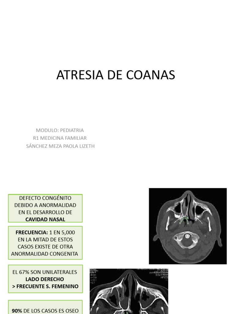 Atresia de Coanas | PDF | Salud y bienestar