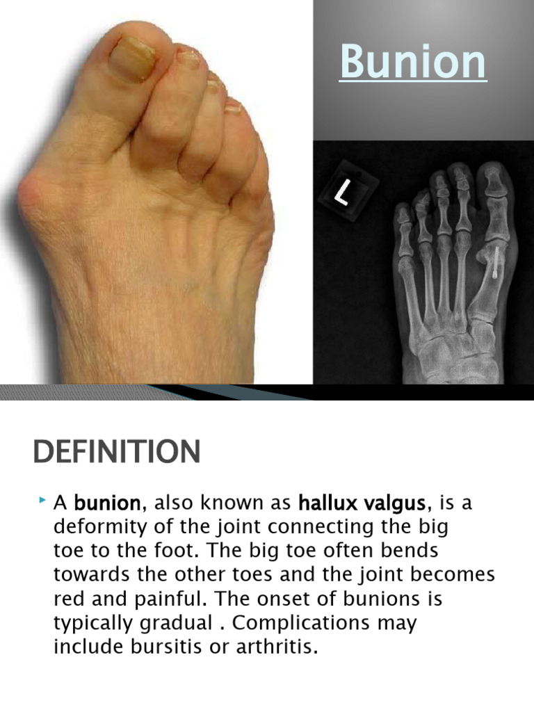 Bunion | PDF | Limbs (Anatomy) | Lower Limb Anatomy