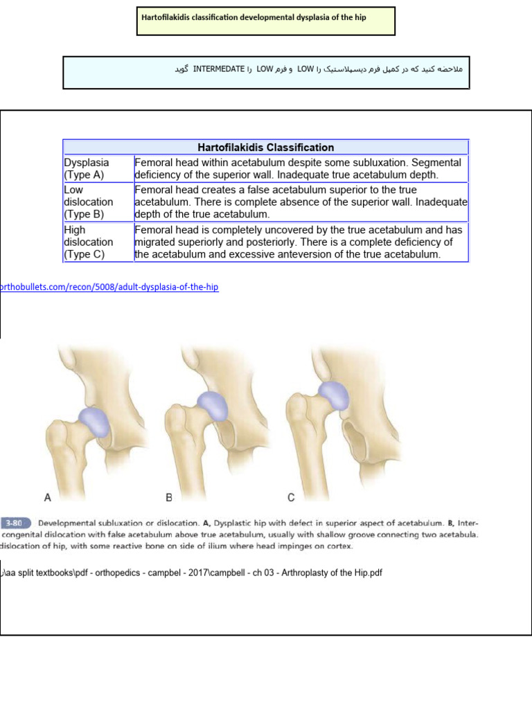 Hartofilakidis Classification Developmental Dysplasia of The Hip | PDF ...