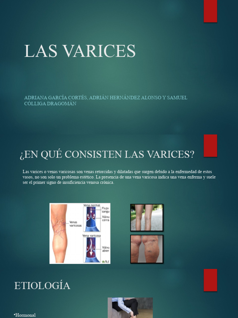 Las Varices | PDF | Venas varicosas | Medicina CLINICA