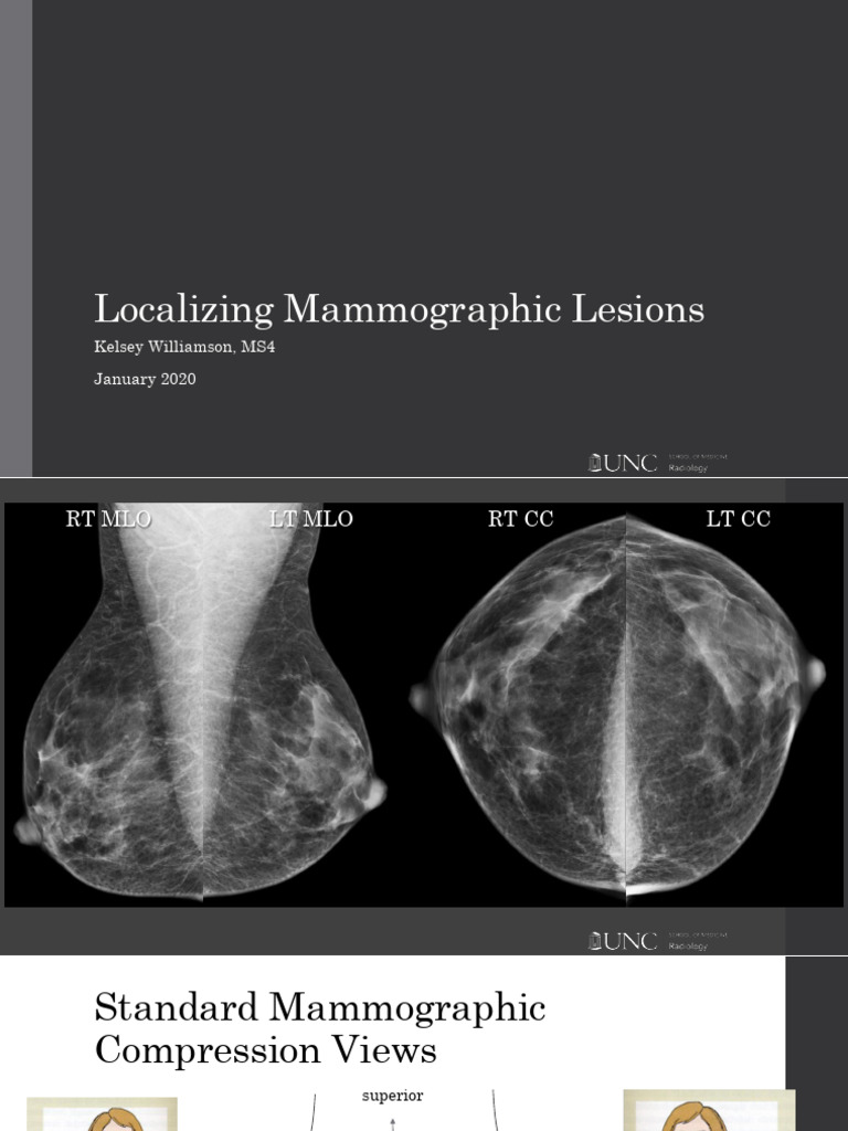 Localizing Mammographic Lesions M4WK | PDF | Mammography | Breast Cancer