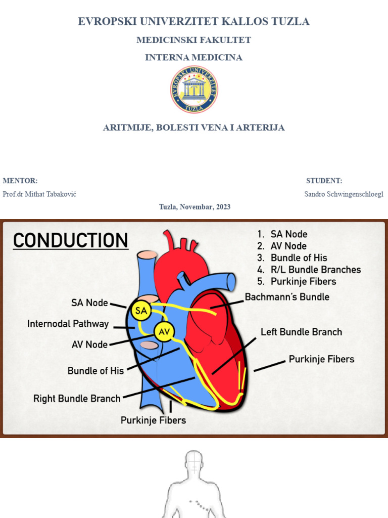 Interna - Aritmije | PDF