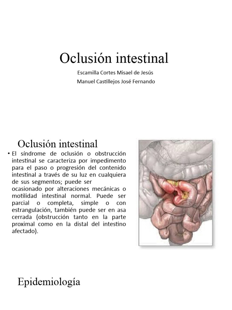 Oclusion Intestinal | PDF