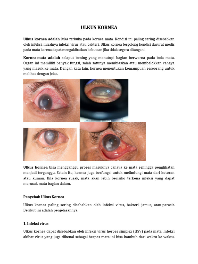 Ulkus Kornea | PDF