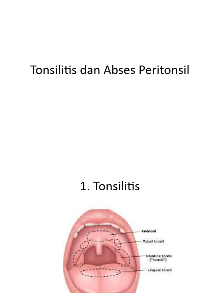 Tonsilitis | PDF