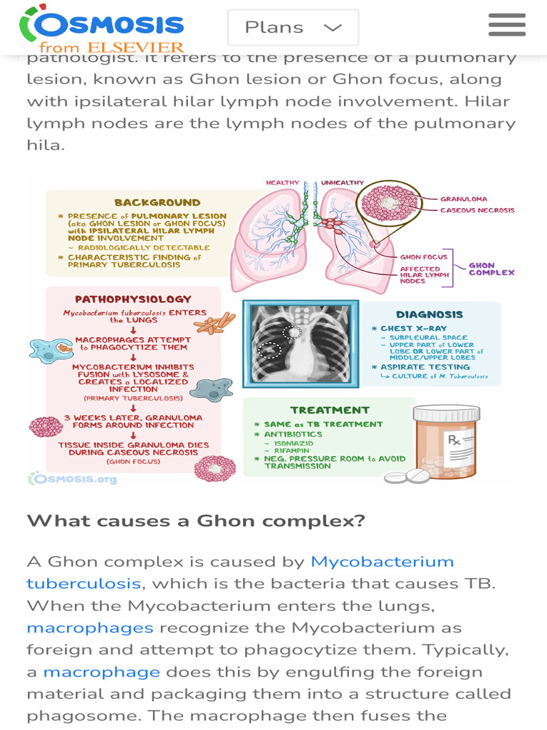 Ghon Complex What Is It, Causes, Diagnosis, Treatment, and More Osmosis ...