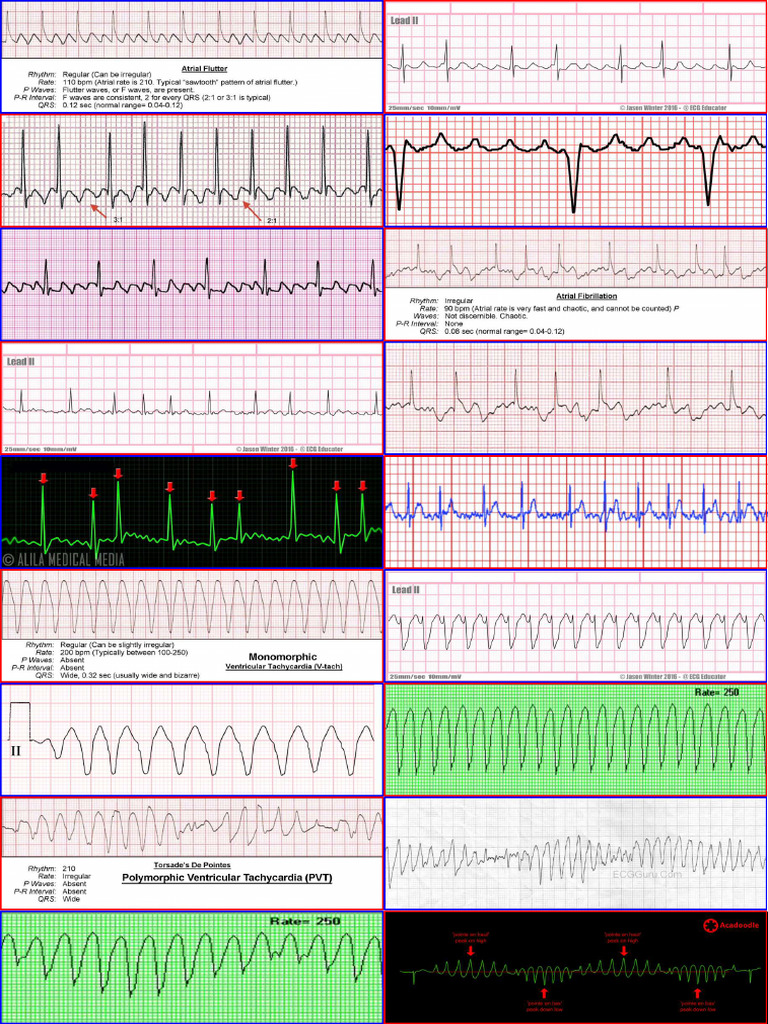 ECG/EKG Flashcards | PDF