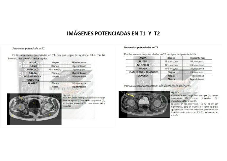 Imágenes Potenciadas en T1 y T2 | PDF