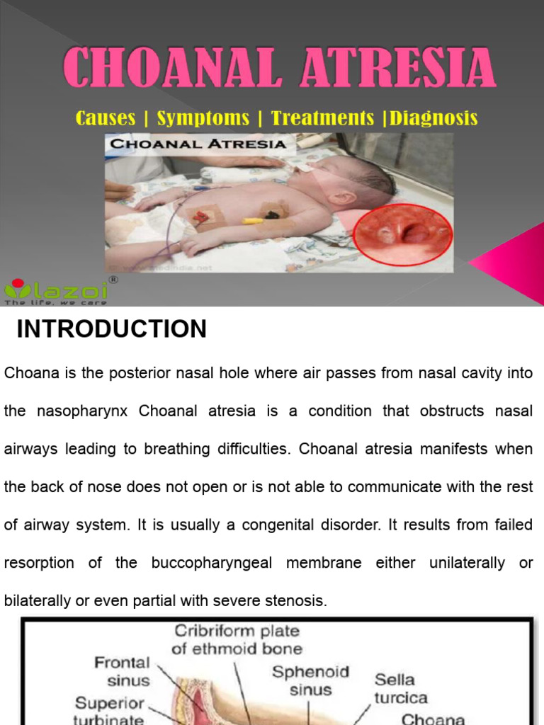Choanal Atresia | PDF | Human Nose | Respiratory System