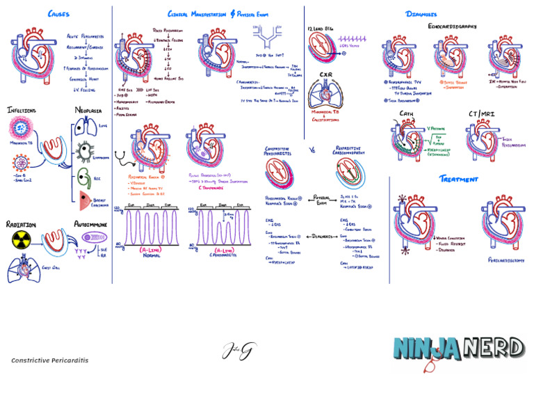 Cardiovascular Pathology - 016) Constrictive Pericarditis ...