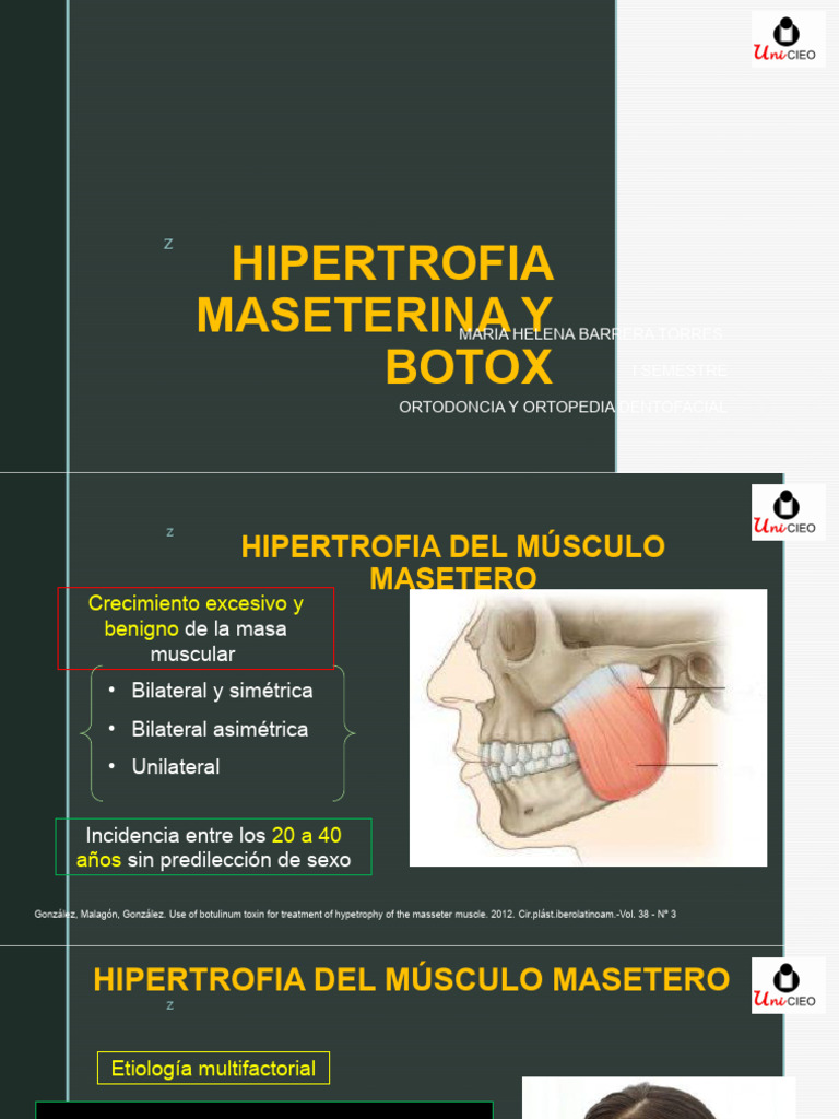 Tratamiento de Hipertrofia Maseterina con Botox | PDF | Medicina ...