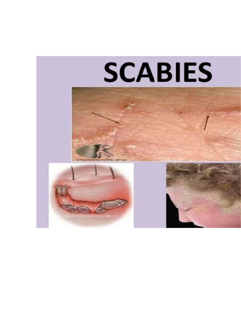 Skabies Dokumen | PDF