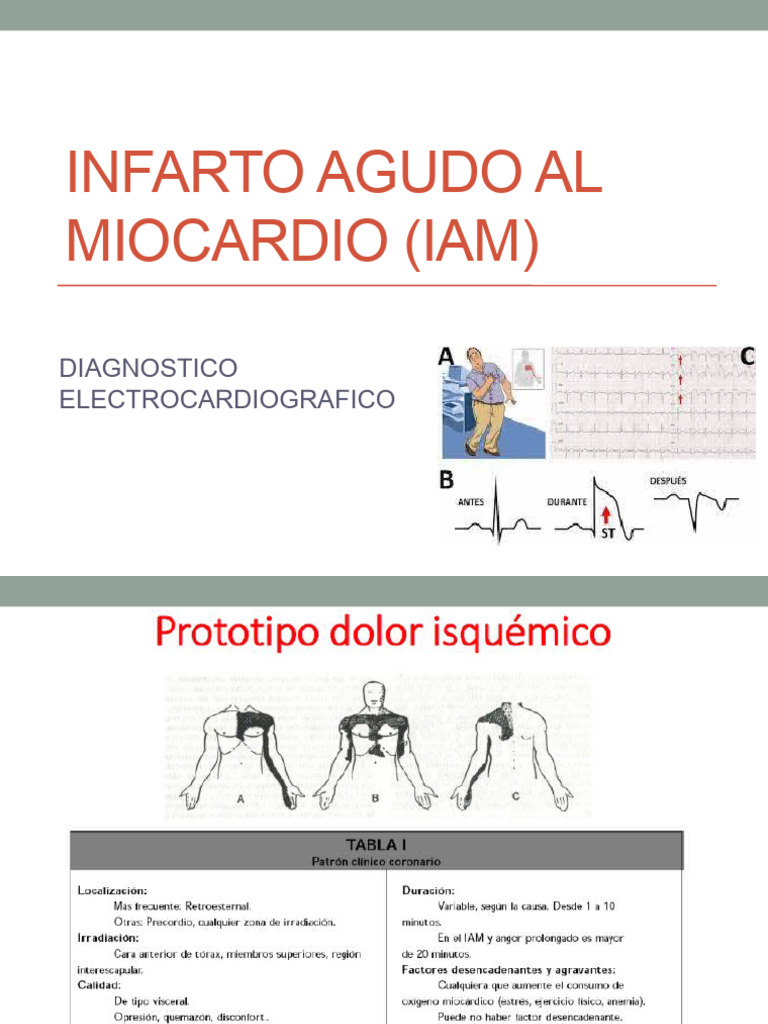 3dx EKG IAM | PDF | Electrocardiografia | Infarto de miocardio