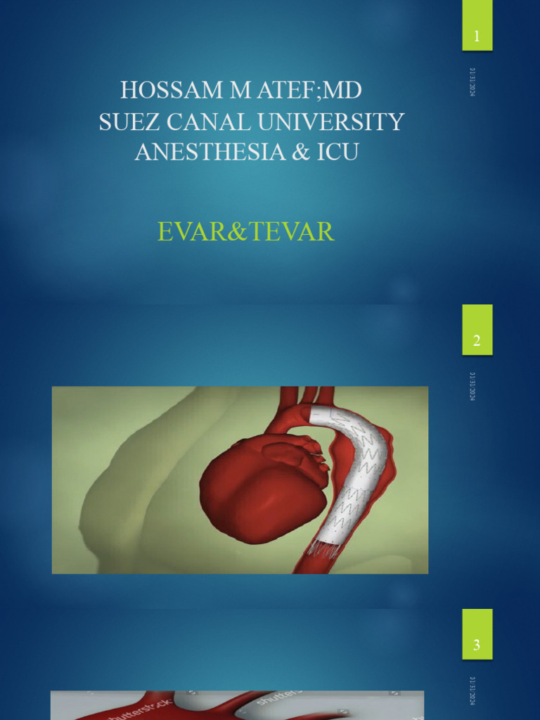 Tevar (Thoracoendovasular Aortic Repair) | PDF | Interventional ...