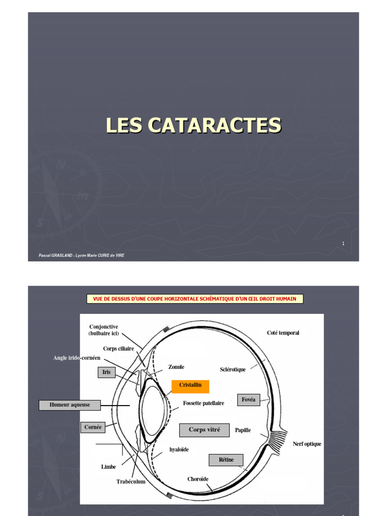 Comprendre les cataractes et leurs types | PDF | Cataracte ...