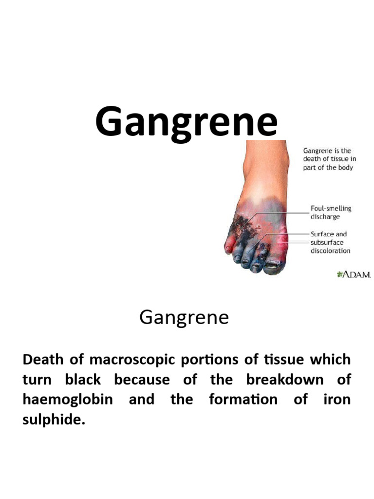 Gangrene | PDF