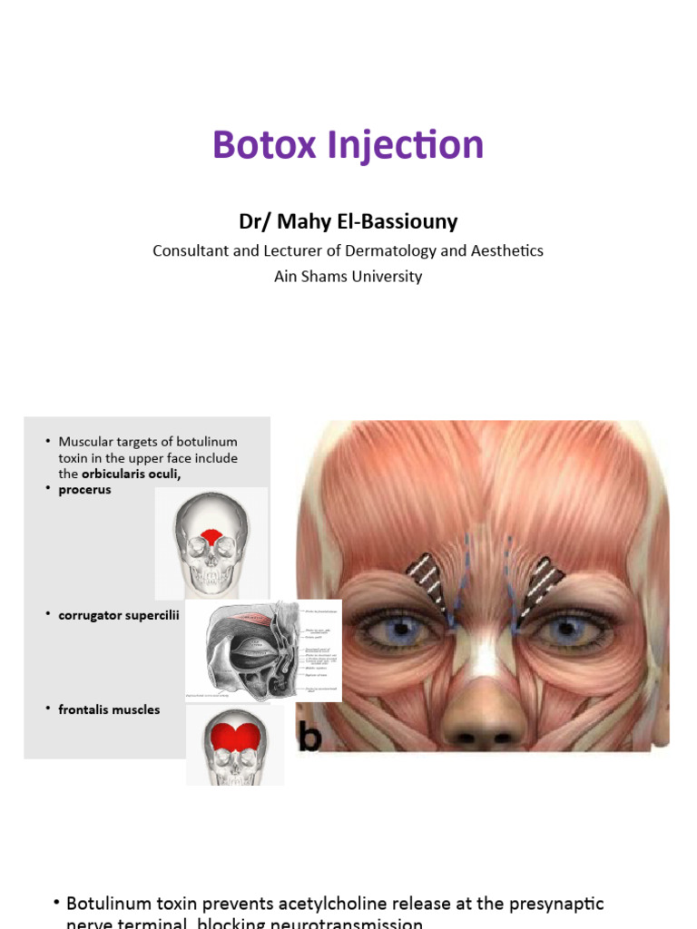 Botox Injection Techniques and Anatomy | PDF | Botulinum Toxin ...