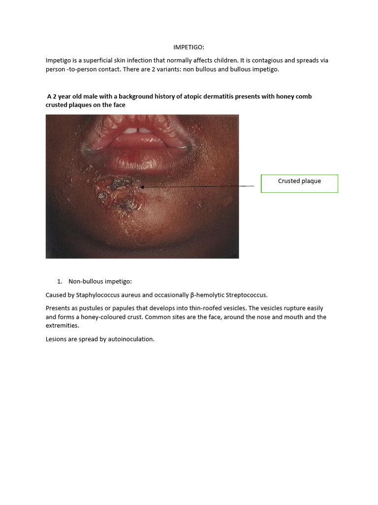 IMPETIGO | PDF | Staphylococcus | Staphylococcus Aureus