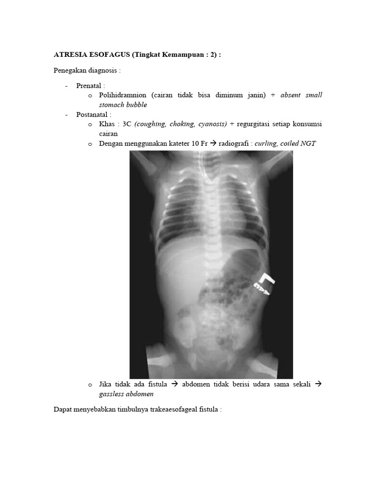 Atresia Esofagus | PDF