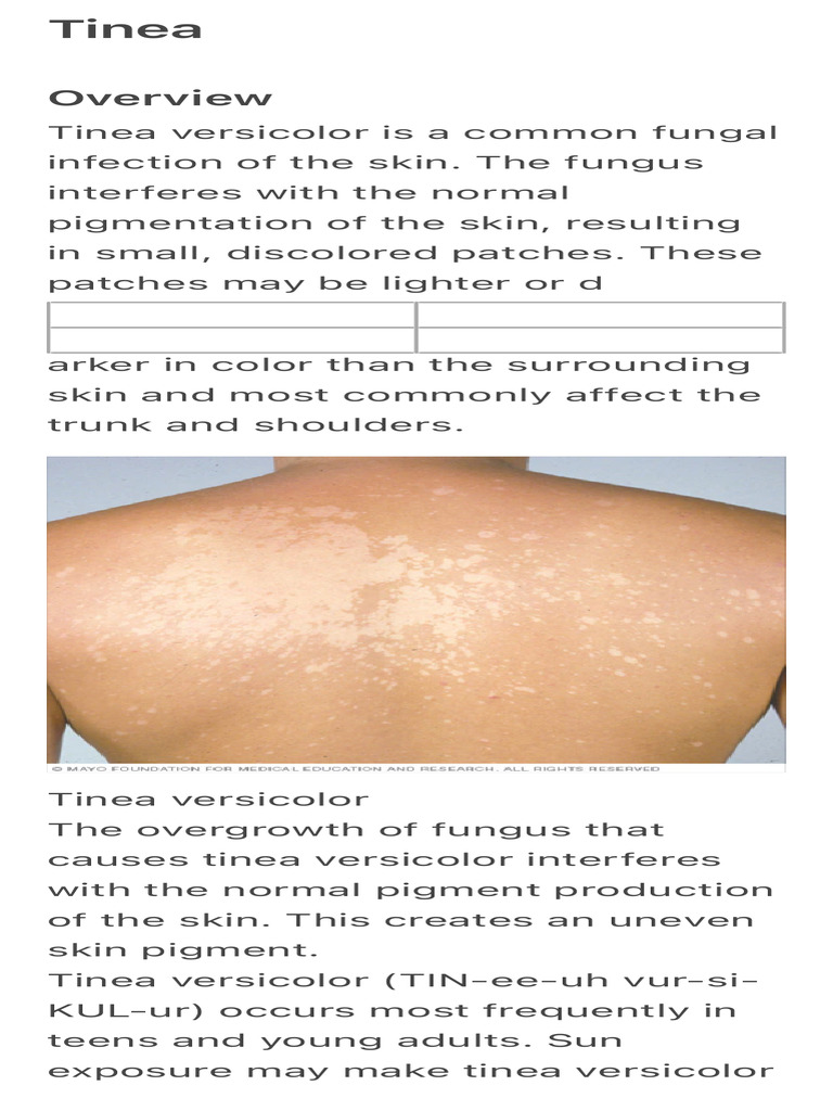 Tinea 488447884322 | PDF | Immunology | Diseases And Disorders