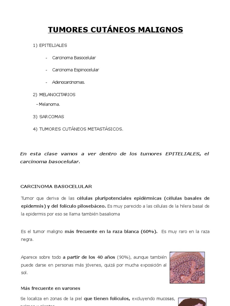 TUMORES Cutáneos Malignos | Metástasis | Cáncer TUMORES Cutáneos Malignos | Metástasis | Cáncer
