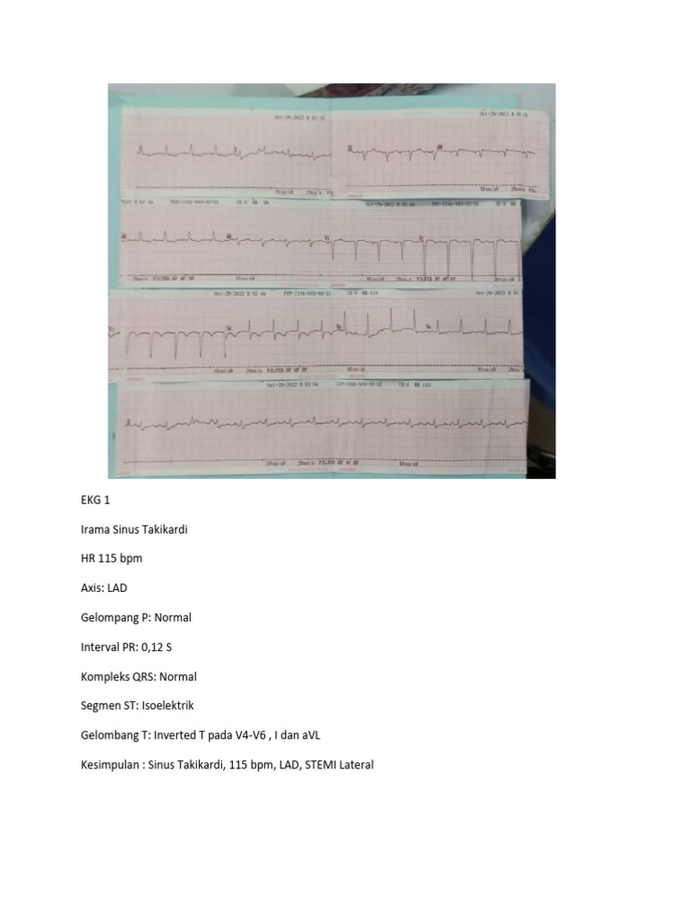 Tugas EKG 3 Rizki Pratama | PDF