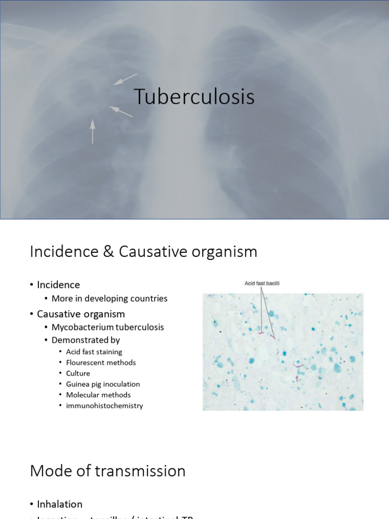 Tuberculosis | PDF