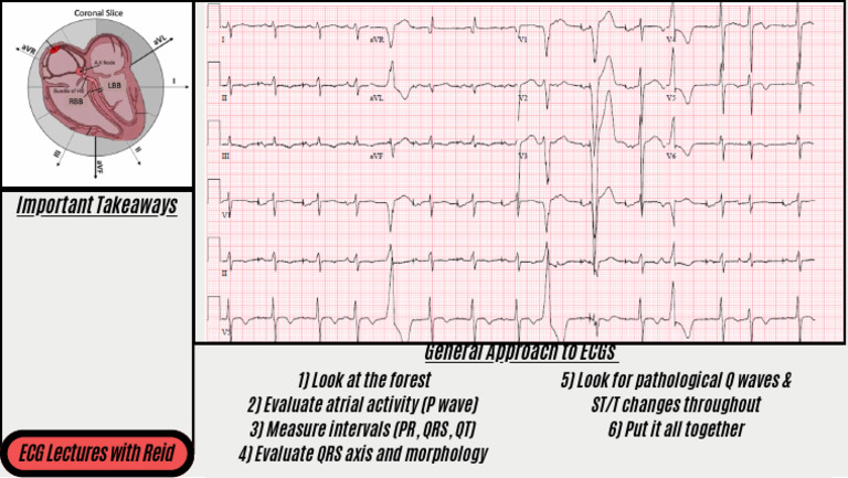ECG Interpretation: Key Steps & Tips | PDF