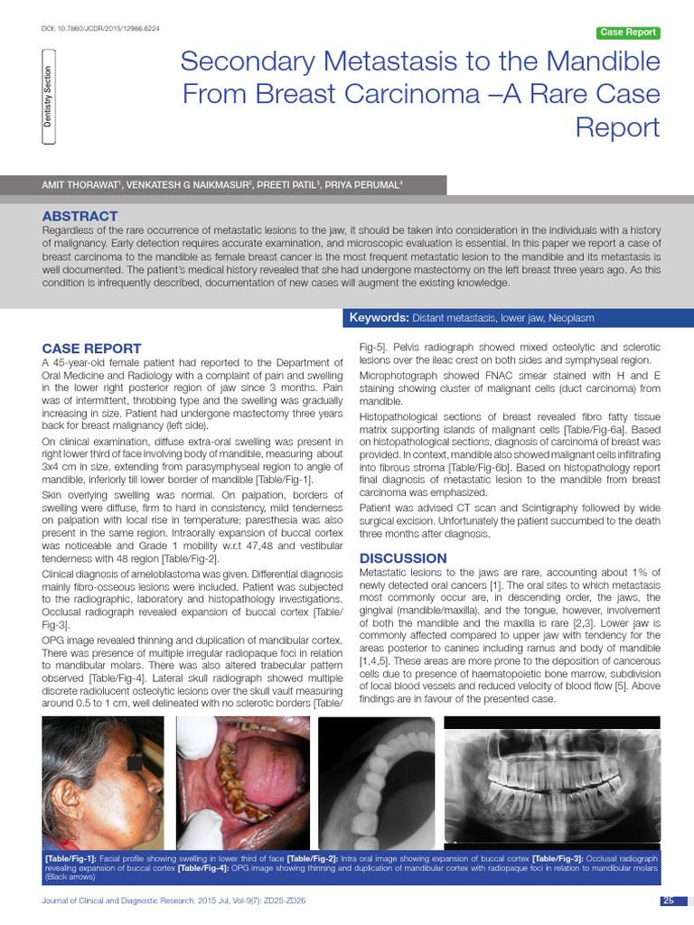 Mandibular Mets From Known Breast Ca | PDF | Metastasis | Breast Cancer