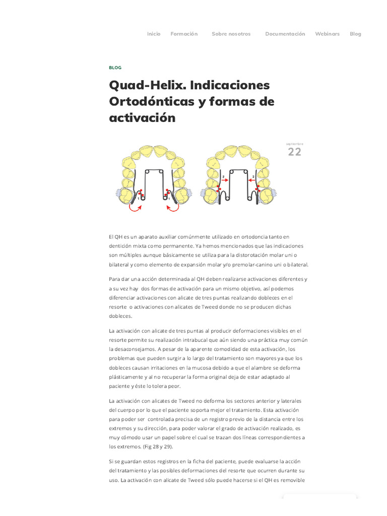 Quad-Helix. Indicaciones Ortodónticas y Formas de Activación | PDF ...