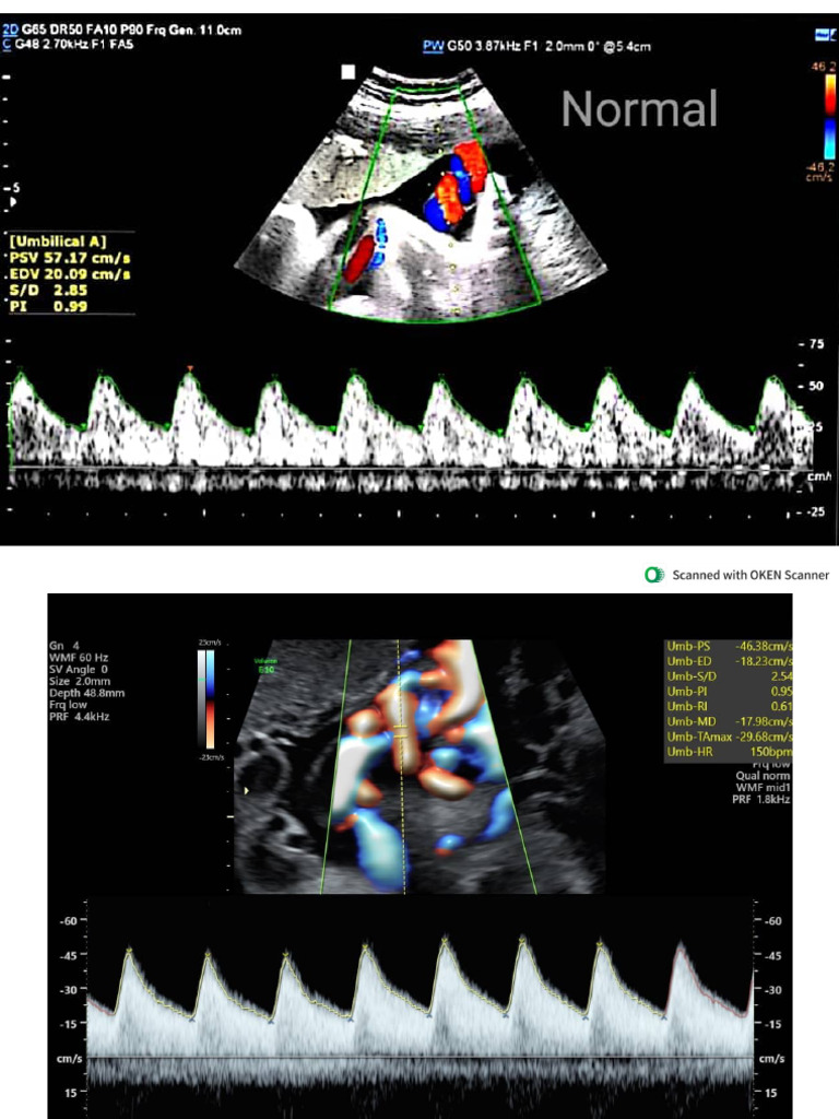 Umbilical Artery Doppler Images | PDF